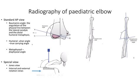 Fractures Around Elbow Lateral Condyle And Intercondylar Fractures Ppt