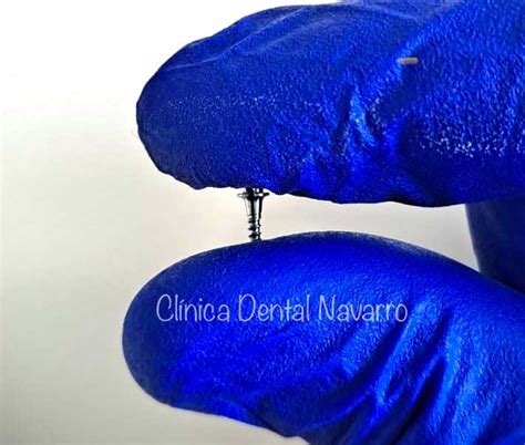 Microtornillos en ortodoncia Qué son Cuándo se usan