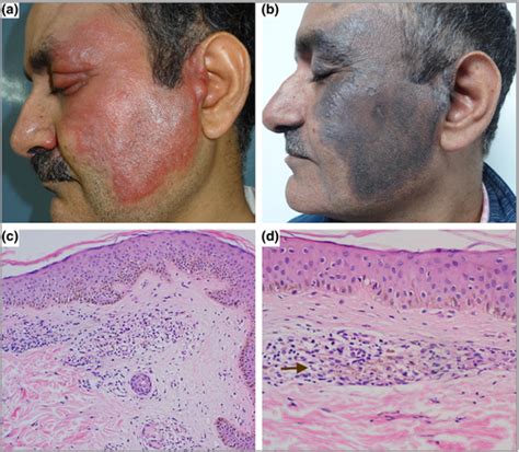 Image Gallery Clofazimine‐induced Hyperpigmentation Of Leprosy Plaques Bishnoi 2019