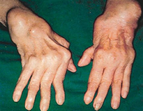 Rheumatoid Arthritis Clinical Tree
