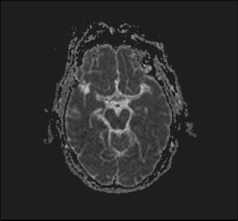 Diffusion Weighted Magnetic Resonance Imaging Was Normal Download