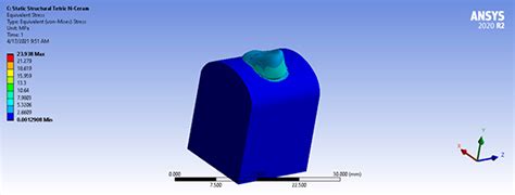 Finite Element Analysis Of Abutment Tooth Ccide