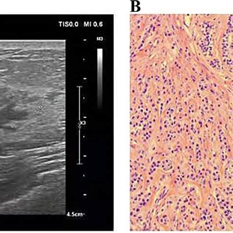 A Ultrasound Detected An Irregular Shaped Hypoechoic Right Breast Mass