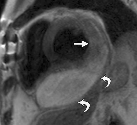 Mr Imaging Of Myocardial Infarction Radiographics