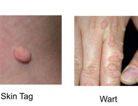 What Is Difference Between Skin Tag And Wart At Allyson Byerly Blog