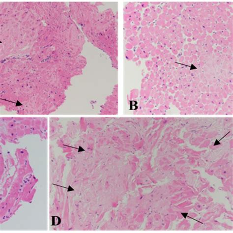 Morphology Of Cardiac Amyloidosis The Amyloid Deposits May Be Very Download Scientific Diagram