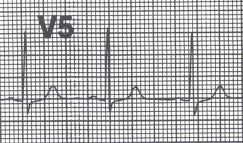 Sinus Rhythms Flashcards Quizlet