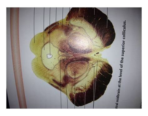 Midbrain Cross Section Quiz