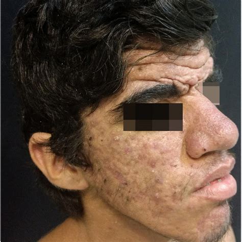 Erythematous Papules And Pustules On Face Skin Thickening And