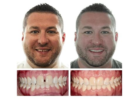 Gap Teeth Treatment In Johnson City Beautiful Smile Guide