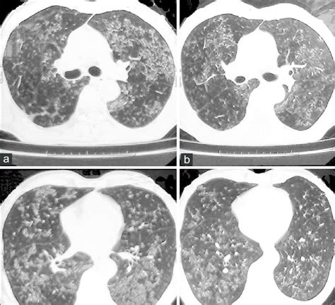 Hrct Scan Of Thorax Showing Bilateral Reticulonodular Opacities D C