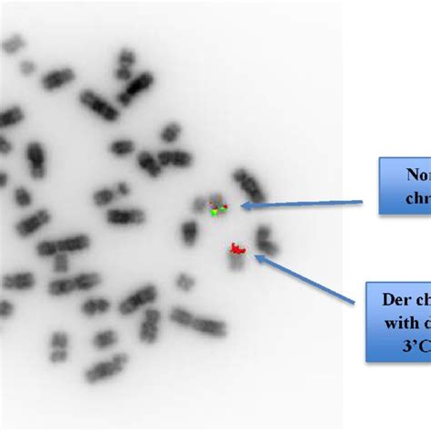 Acute Myeloid Leukemia Karyotypes Involving Abnormalities In The Cbfb