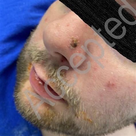 Maculopapular Vesicular And Pustular Lesions With Central Necrosis And