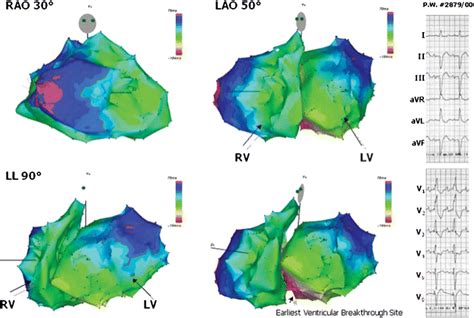 Ecg And Color Coded Electroanatomic Isochronal Maps Of Rv And Lv