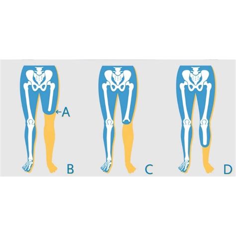 All About Leg Amputation Levels Of Leg Amputation Össur