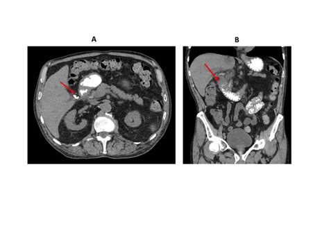 Lyme Carditis Complicating The Presentation Of A Perforated Duodenal