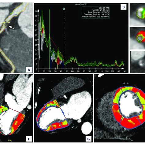 Diagram Of Comprehensive Cardiac Ct After Preparation Ccta Scan Was