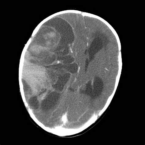 Embryonaler Tumor Mit Mehrreihigen Rosetten Pacs