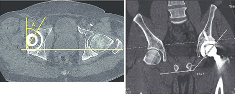 A Handheld Portable Image Based System May Outperform Computer Navigation Or Robotic Platforms