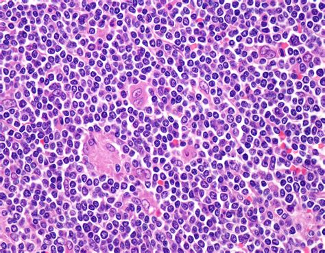 Mantle Cell Lymphoma Light Micrograph Stock Image C057 2852 Science Photo Library