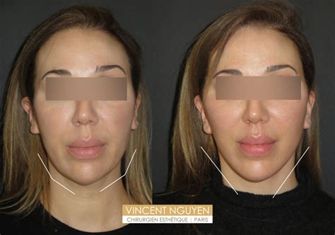 Lifting Cervico Facial Ou Du Bas Du Visage Dr Nguyen Paris