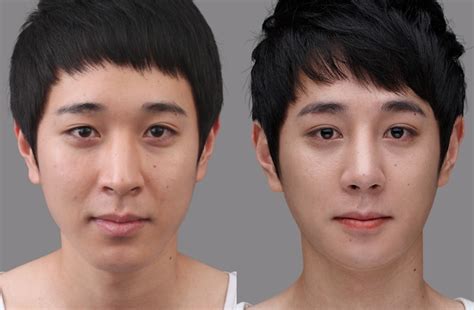 수술 전후 사진 남자광대뼈축소 남자눈성형 남자코성형 원진성형외과