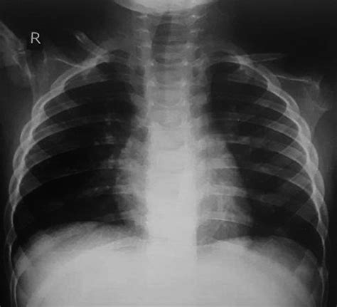 The Cxr Image Of The Patient Revealed Normal Scene Without Remarkable Download Scientific