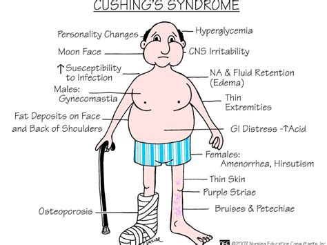 Cushings Syndrome Endocrinology Ppt Ppt