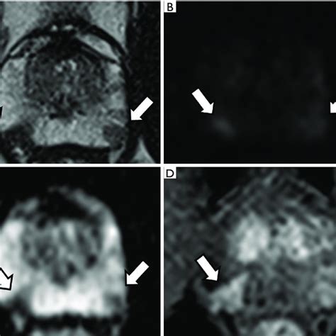 Bilateral Tumour Of The Peripheral Zone Of The Prostate Arrows On