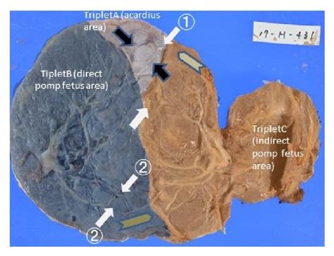 A Case Of Monochorionic Triamniotic Triplet Pregnancy With Trap Sequence Successfully Treated