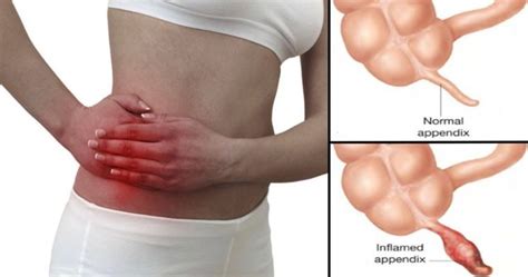 5 Warning Signs Your Appendix Is About To Burst Doctorbabu