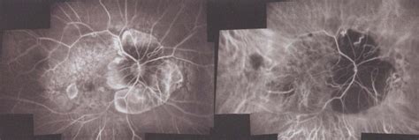 二、5岁分组的眼底改变的演变 青少年近视形成机制以及预测与防控 医学