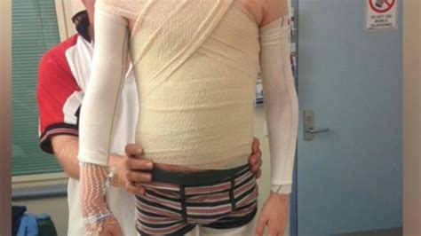 Eczema Drug Dupilumab Approved For Use In Australian Teenagers