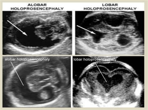 Neonatal Head Ultrasound Technique