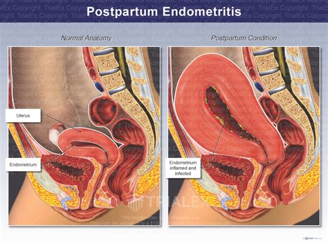 Postpartum Endometritis