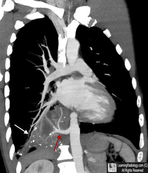 Learning Radiology Bronchopulmonary Sequestration
