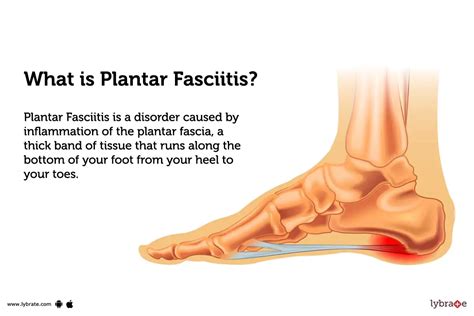 Plantar Fasciitis Swelling On Side Of Foot Cheap Sale