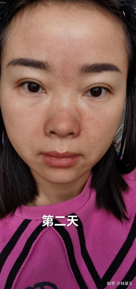 记录微针过程 知乎