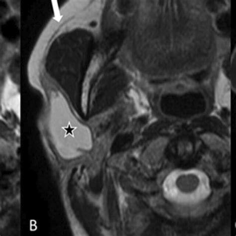 Lipoma An 82 Year Old Female With An Incidental Finding Of Lipoma