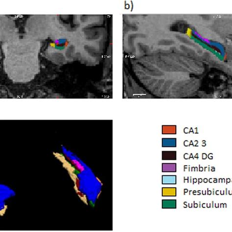 Hippocampal Subfields Segmentation In One Subject A Coronal And B