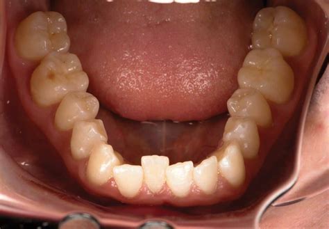 Suresmile Aligners And The Class I With Moderate Class Iii Pattern