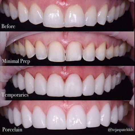 Porcelain Veneers Artofit