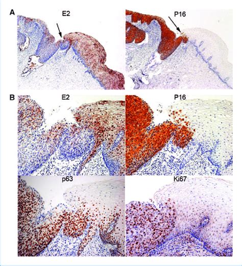 Staining Of E2 Does Not Coincide With Staining Of P16 And Proliferation