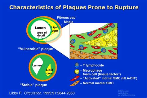 PPT Pathogenesis Of Acute Coronary Syndromes Nathan Wong PowerPoint
