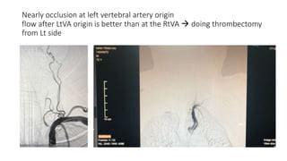 Tandem Occlusion Of VERTEBRAL BASILAR ARTERY OCCLUSION PPTX