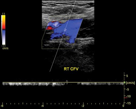 Venous Doppler Sonography Of The Extremities A Window To Pathology Of