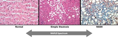 Nafld And Nash Research Update Mayo Clinic