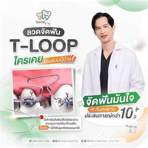 🙋🏻‍♀️ ลวดจัดฟัน T Loop ใครเคยโดนแบบนี้บ้าง สำหรับลวดจัดฟันรูปตัว T