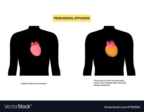 Pericardial Effusion Heart Royalty Free Vector Image