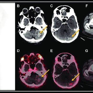 F 18 Fluorodeoxyglucose FDG Positron Emission Tomography PET